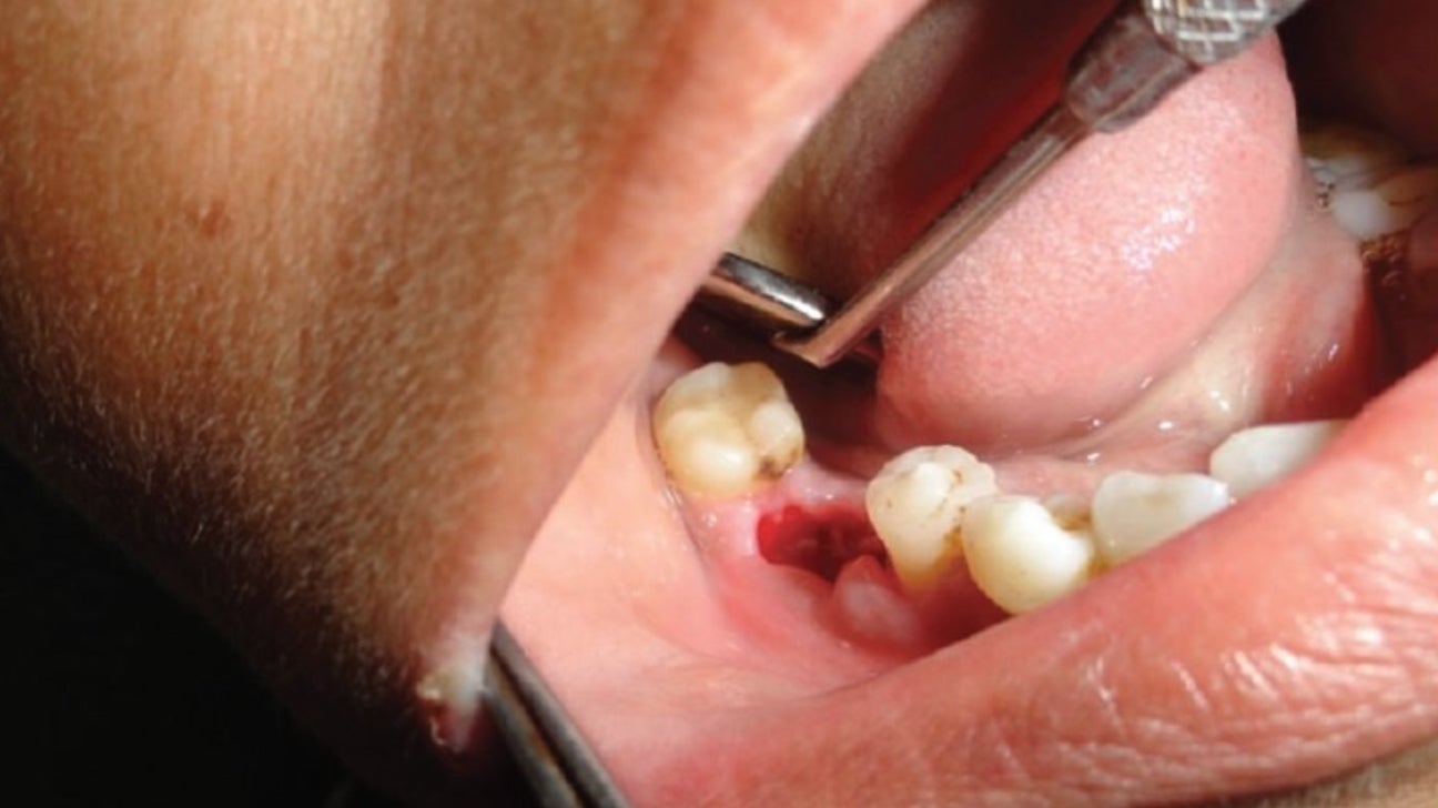 Wisdom Tooth Extraction Hole