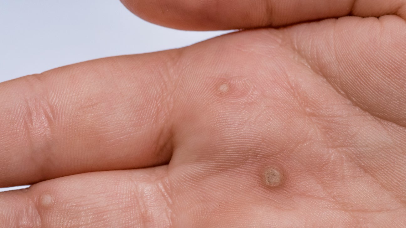 Warts: Types, Causes, Images, Treatment, and More