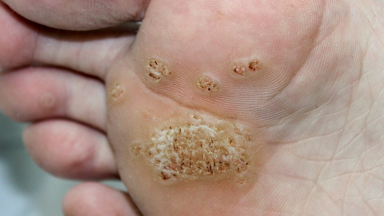 Warts: Types, Causes, Images, Treatment, and More