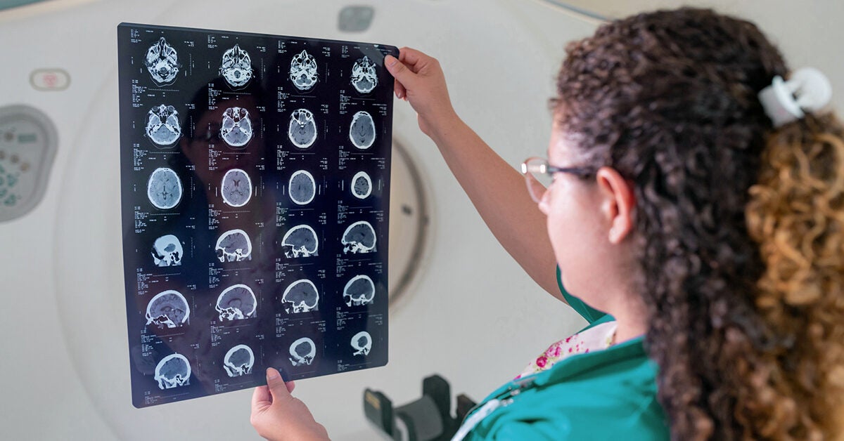 Multiple Sclerosis: Effects on the Brain