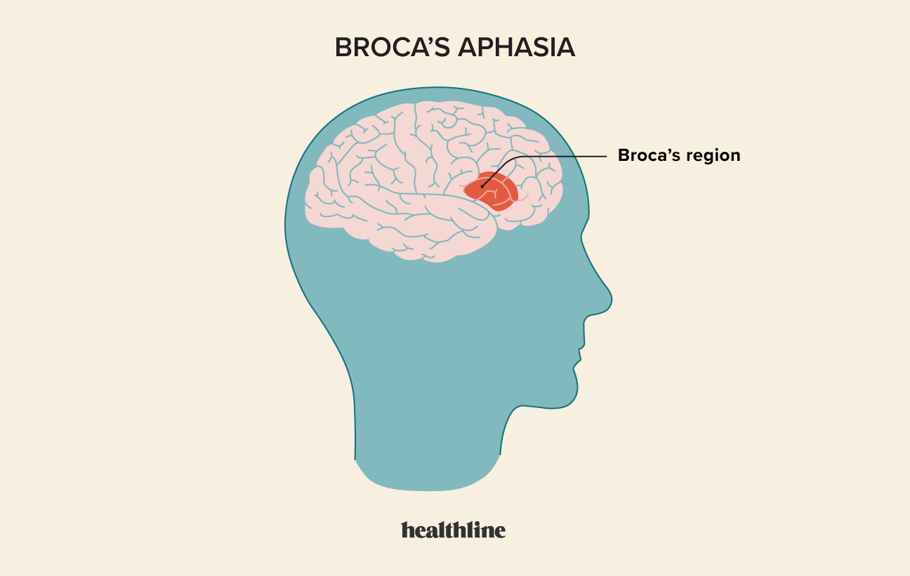 Broca’s Aphasia: Symptoms, Treatments, Types, and Outlook