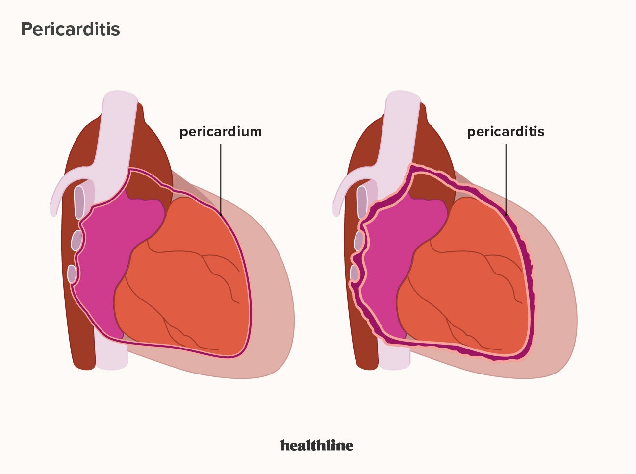 Waterfles Silhouet Pericarditis