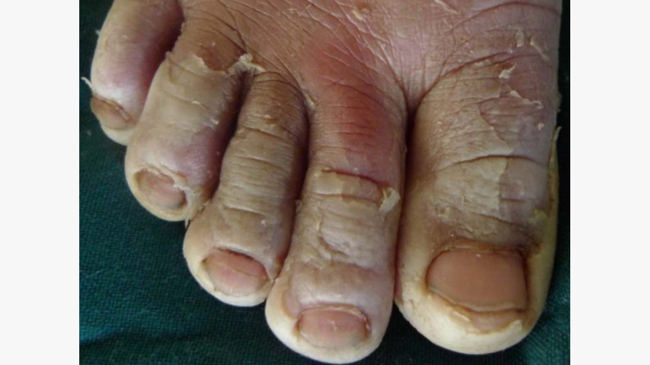 Conditions That Cause Skin Peeling Conditions That Cause Skin Peeling