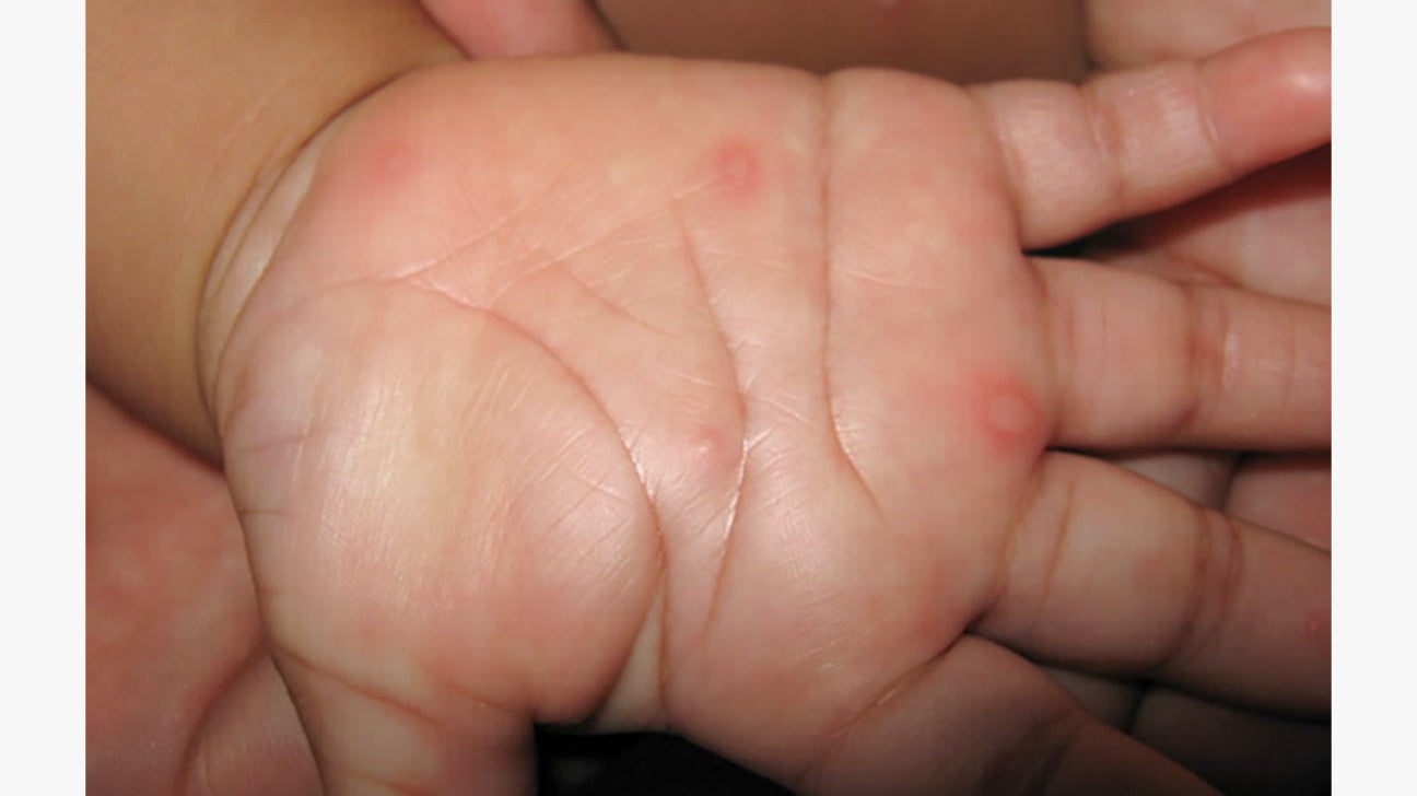 Hand Foot Mouth Rash Causes Infoupdate Hand Foot Mouth Rash Causes Infoupdate
