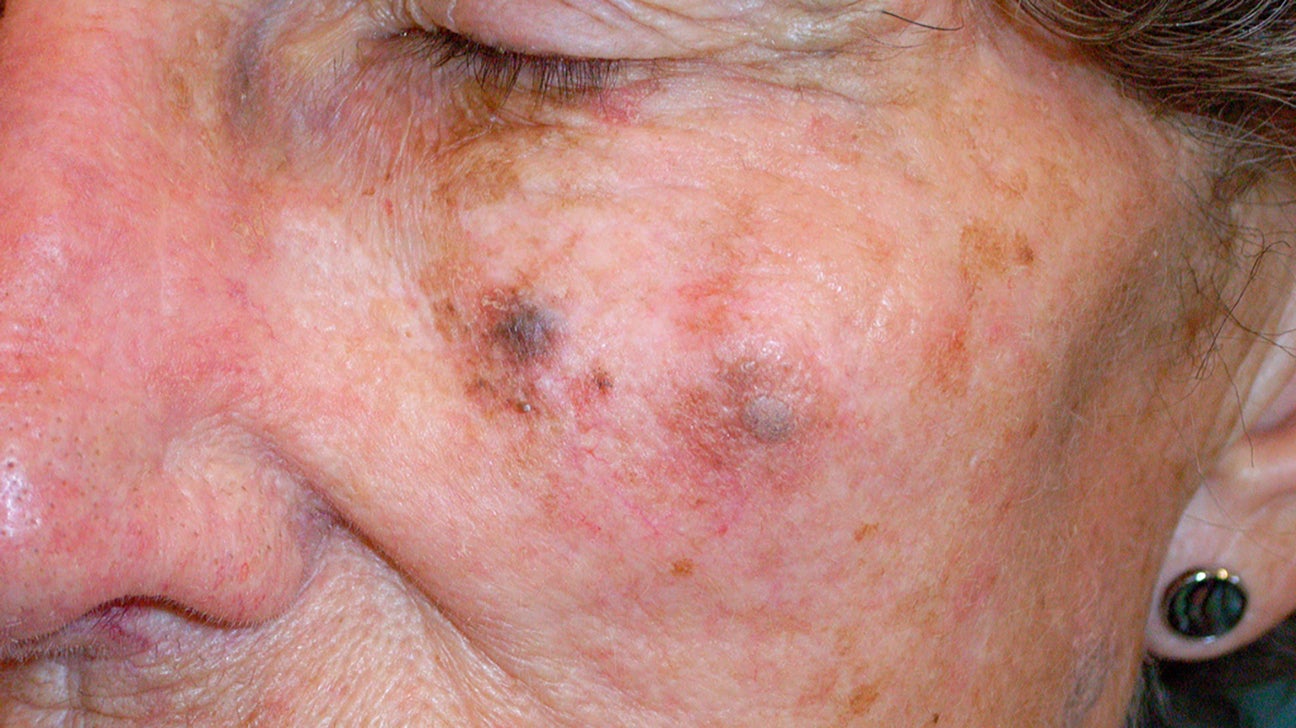 Melanoma Pictures: Skin Changes and What to Look For