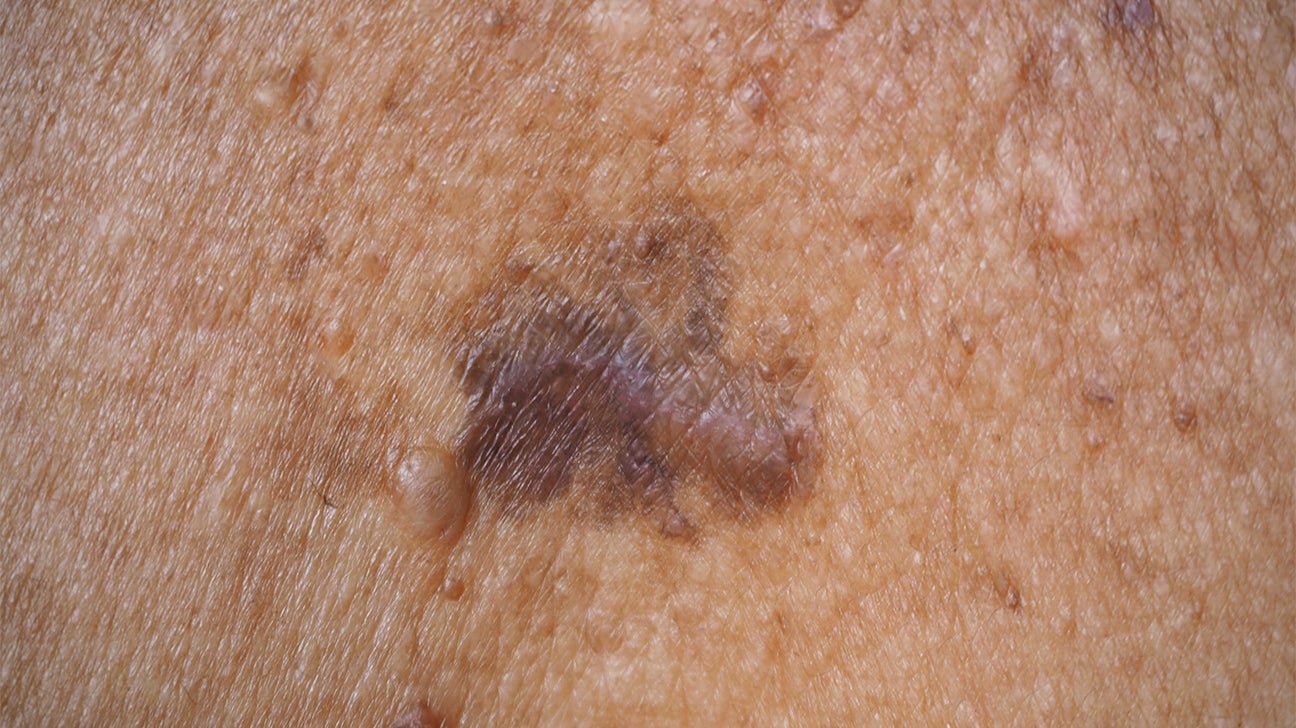 Melanoma Pictures: Skin Changes and What to Look For