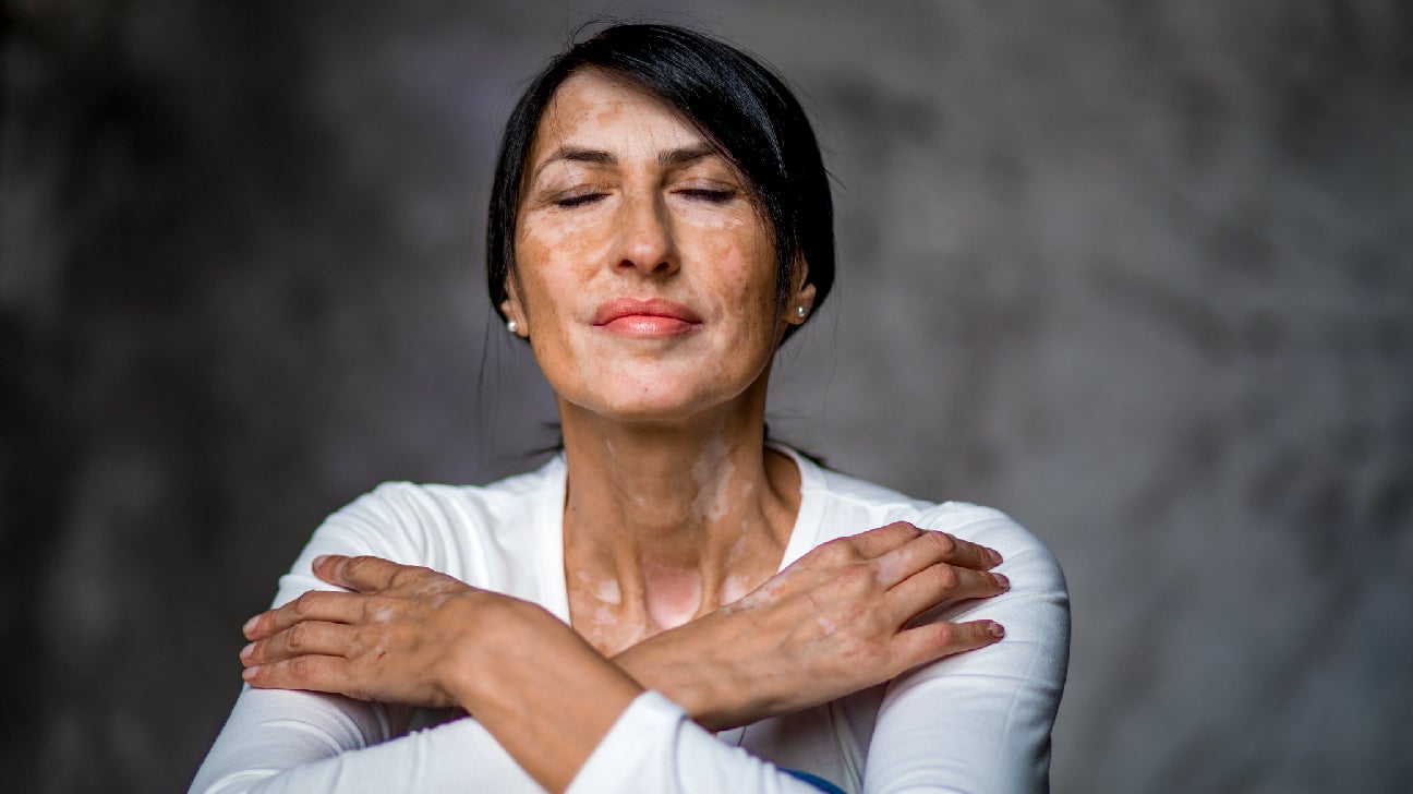 What Does Vitiligo Look Like? Vitiligo Pictures and More