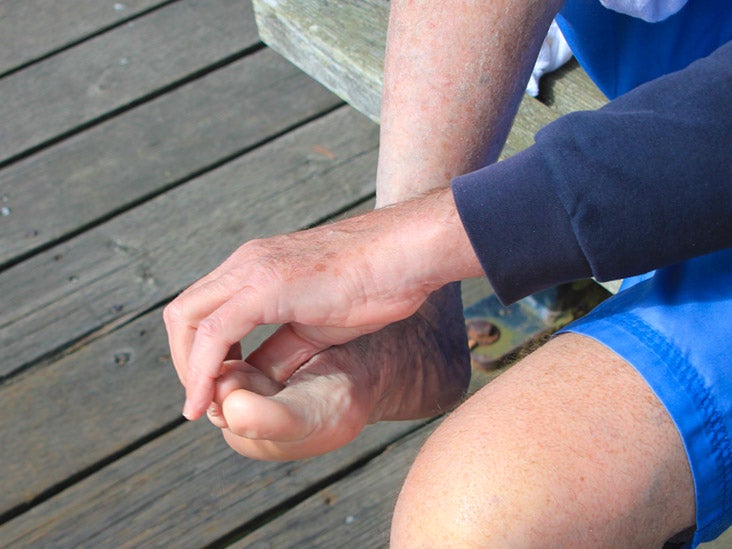 Psoriasis or Athlete’s Foot: What’s the Difference?