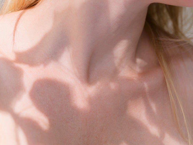 Hyperthyroidism: Causes, Symptoms, Treatment, Diagnosis & More