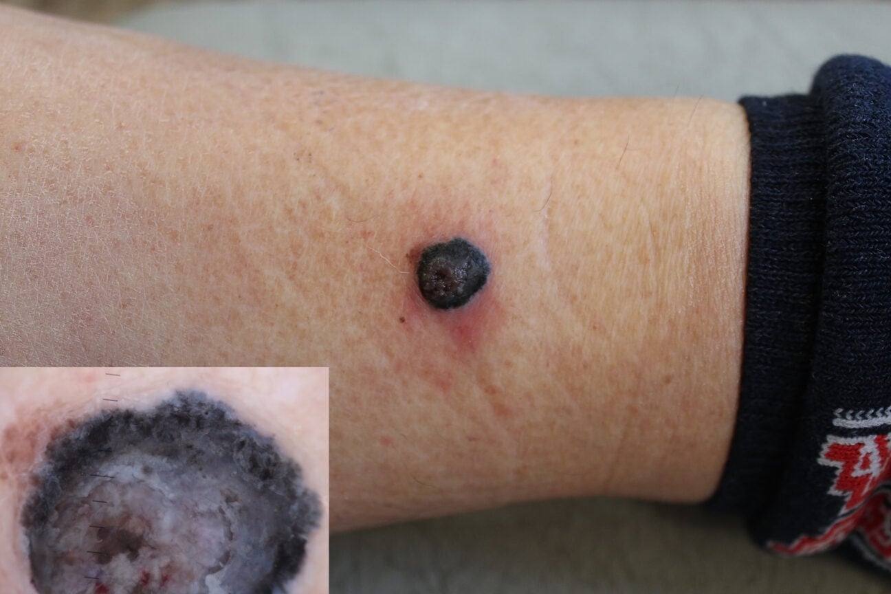 Melanoma Pictures: Skin Changes and What to Look For