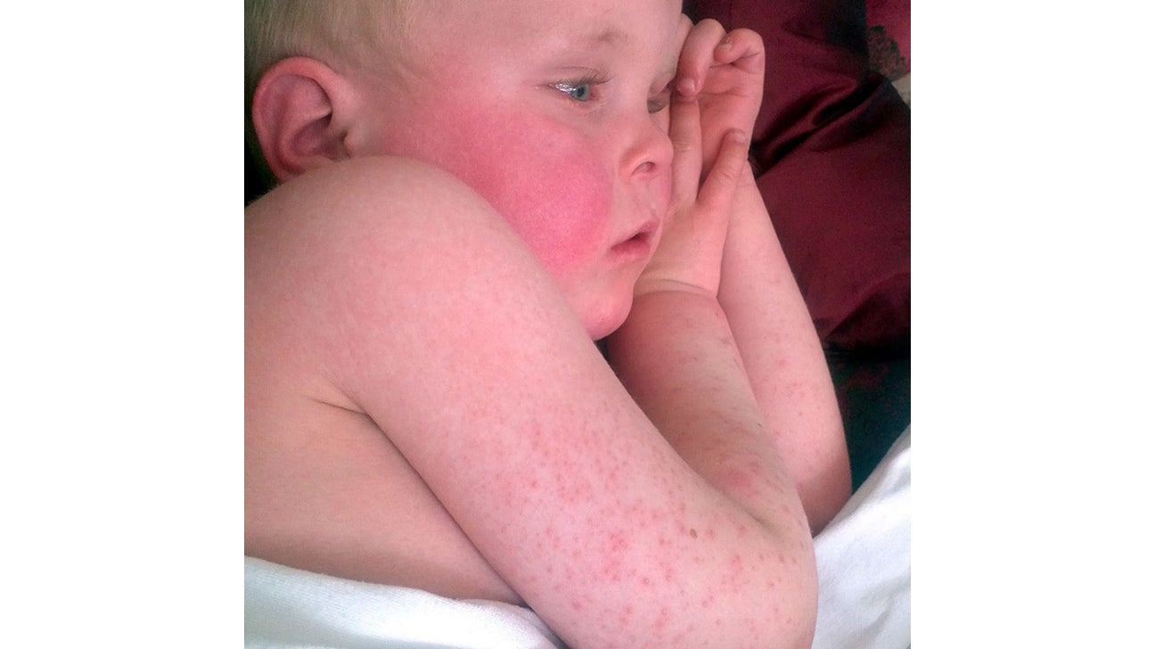 Chest Rash Chest Rash