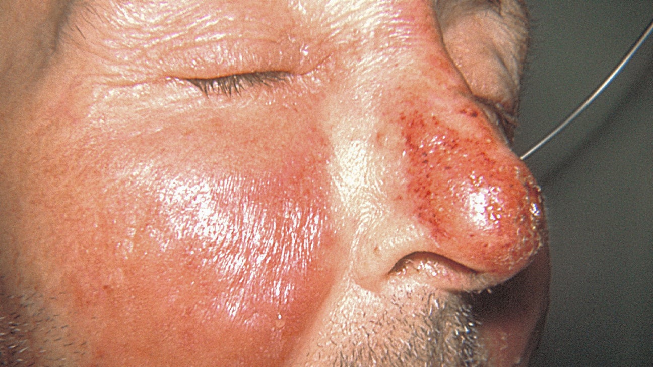 Rash And Skin That Feels Hot To The Touch Causes And Photos
