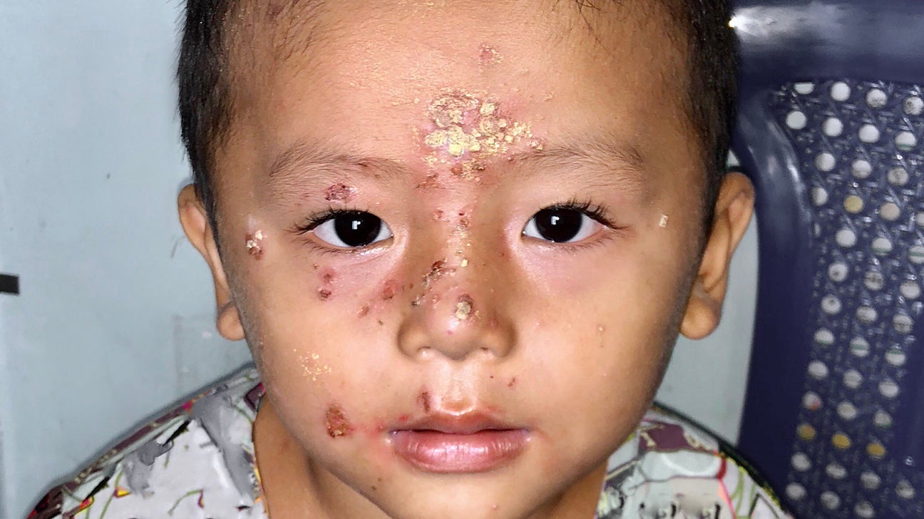 Impetigo Nhs Impetigo Nhs