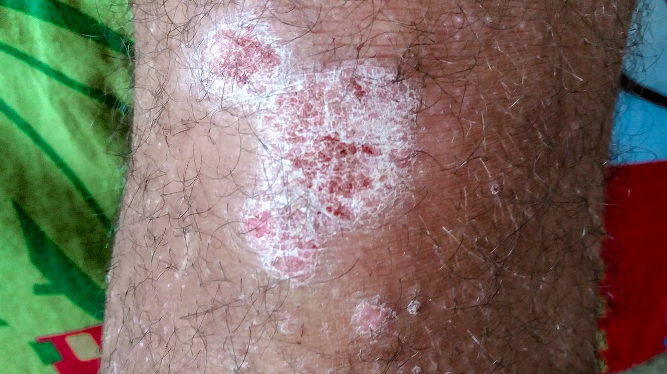 Rash and Skin That Feels Hot to the Touch: Causes and Photos