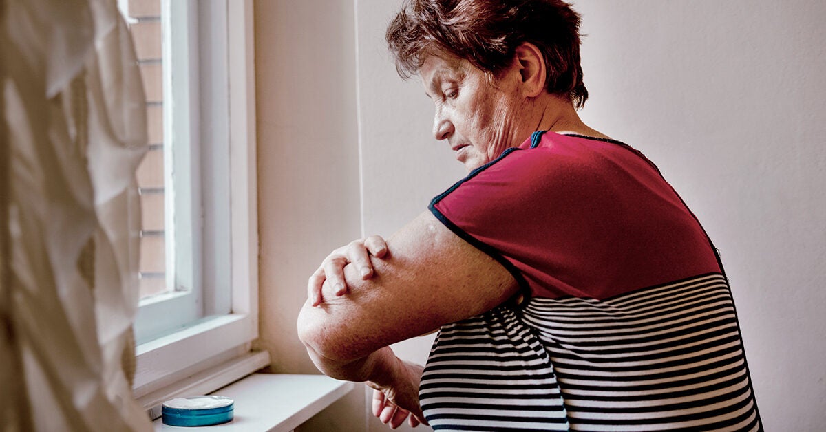 Hives and Parkinson's Disease: Itching, Sweating, Skin Problems