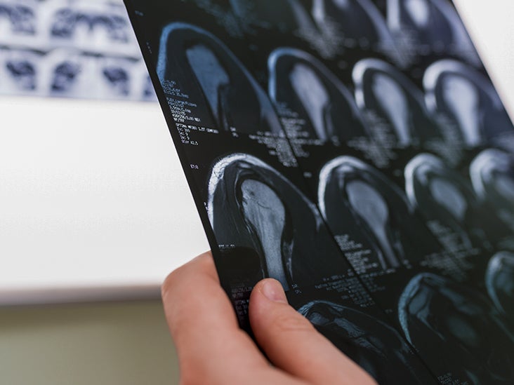 What Is An Arthrogram?