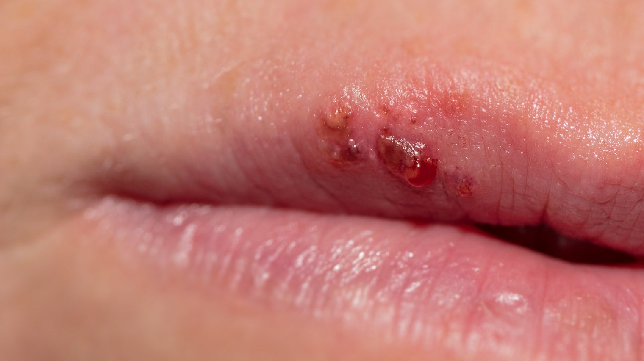 Mouth Sores: Pictures, Causes, Types, Symptoms, and Treatments