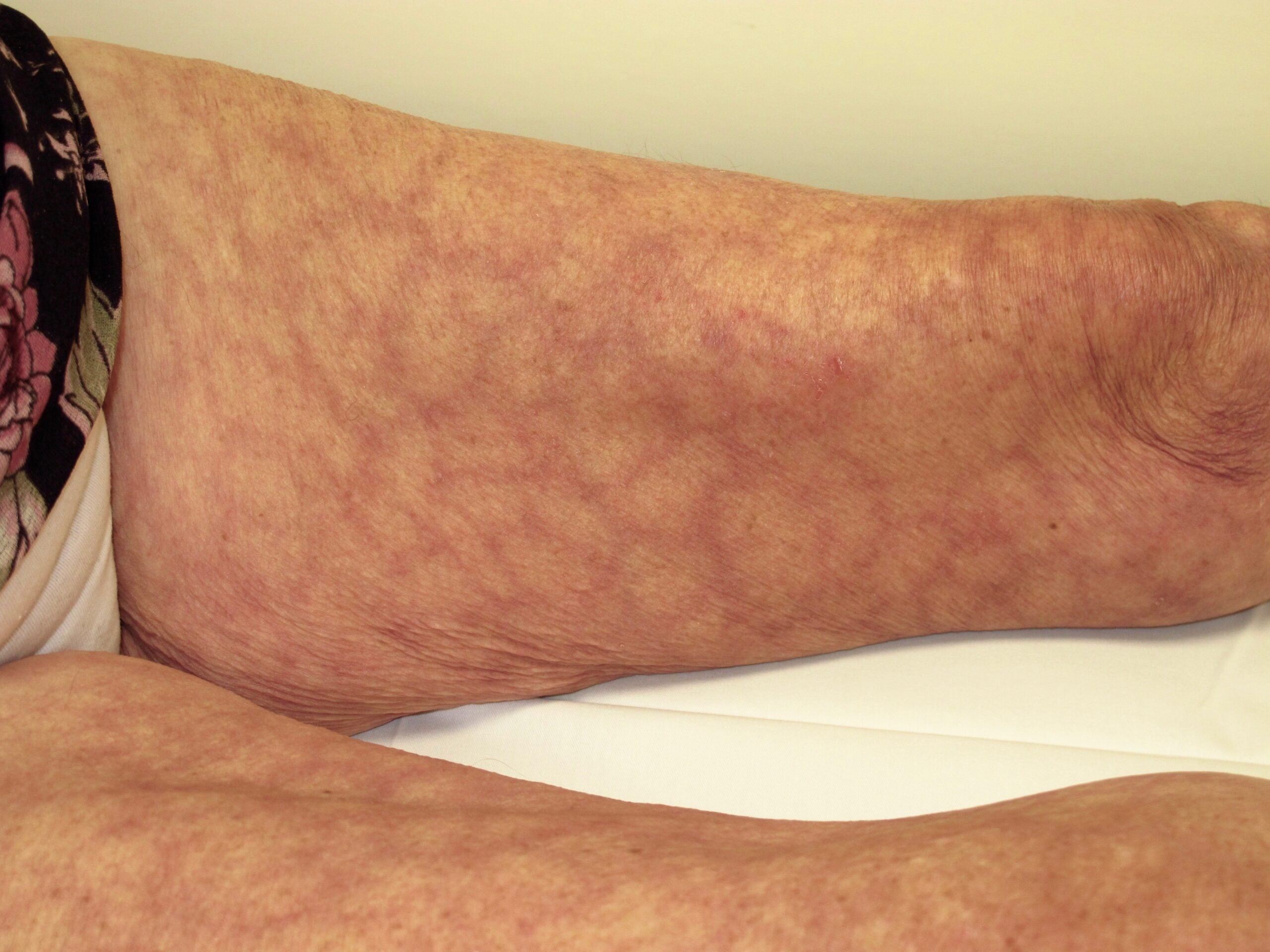 Auftakt Umfrage Benutzer Circulation White Spots On Legs Kl ren 