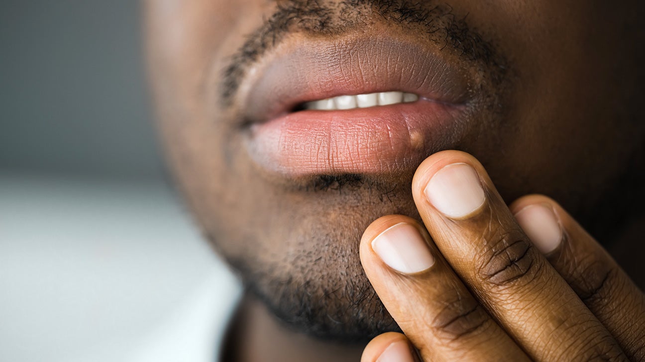 Oral STDs: Symptoms, Treatment, and More