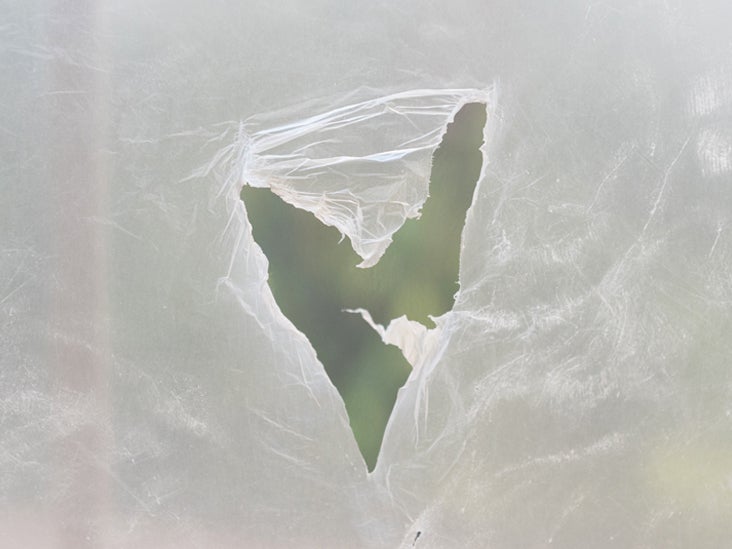 Coronary Artery Dissection (SCAD): Types, Symptoms, Treatment