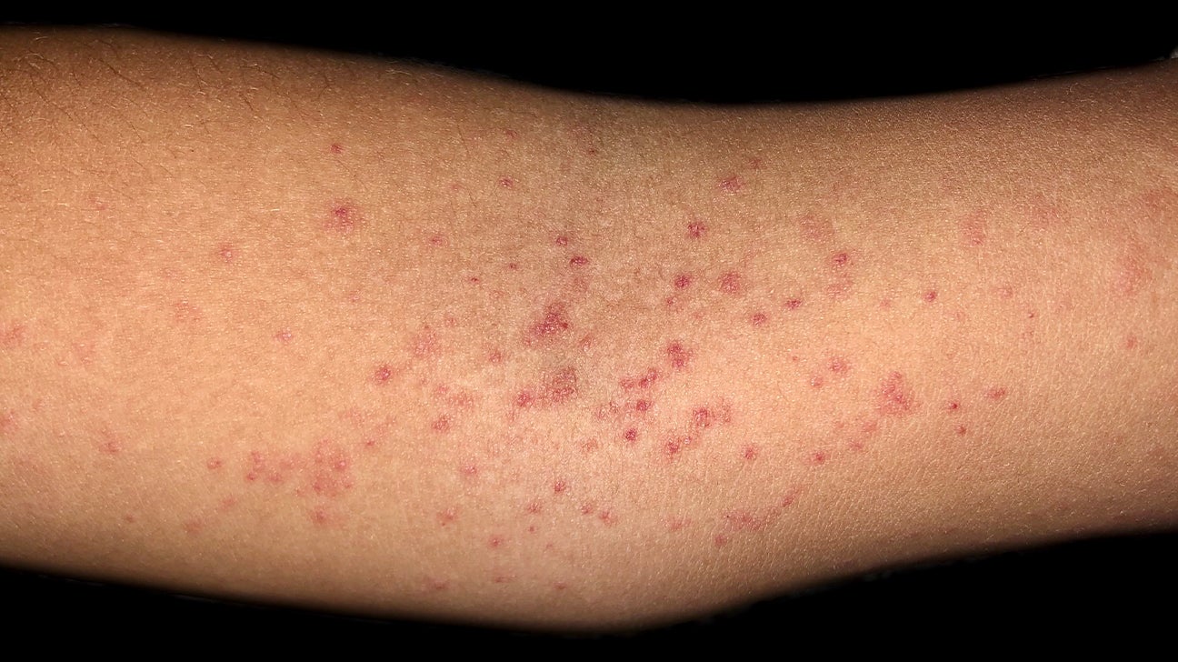 Rash and Swollen Lymph Nodes: Causes, Photos, and Treatment