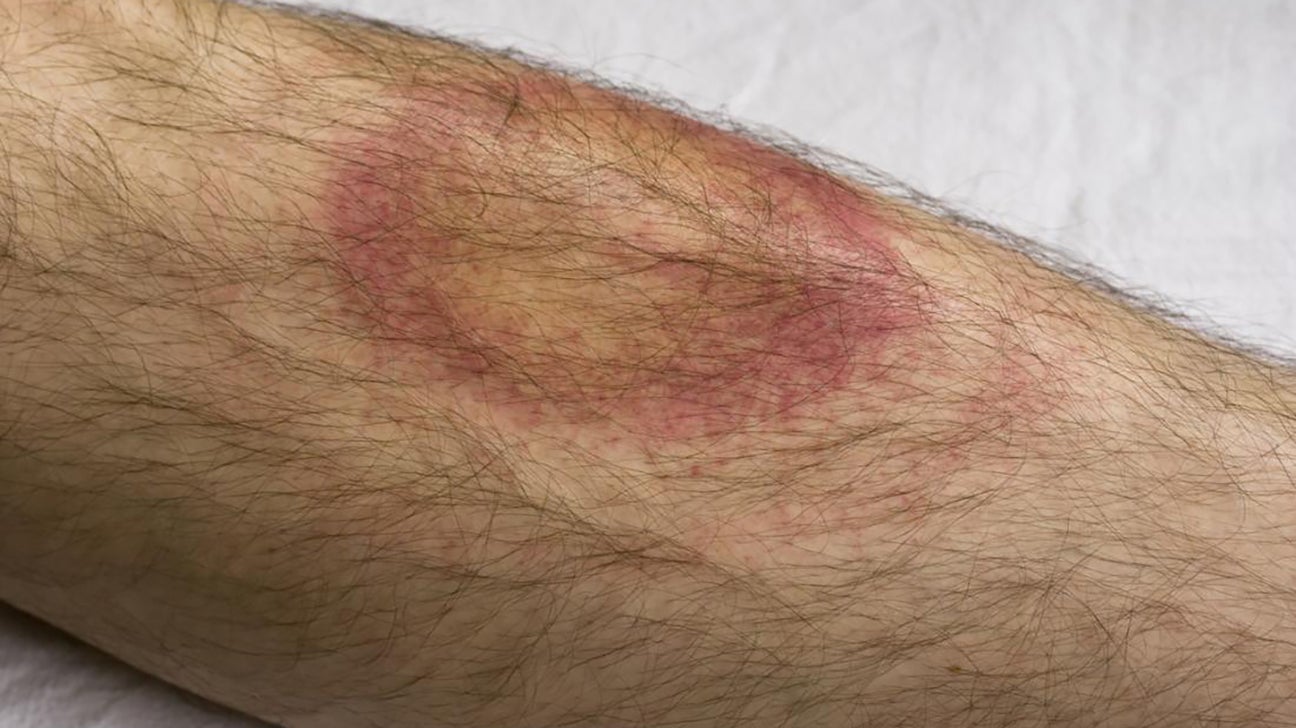 Rash and Swollen Lymph Nodes: Causes, Photos, and Treatment