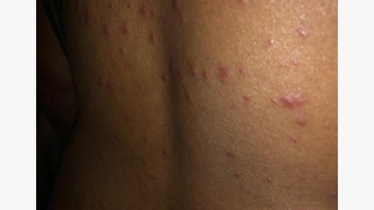 Rash and Swollen Lymph Nodes: Causes, Photos, and Treatment