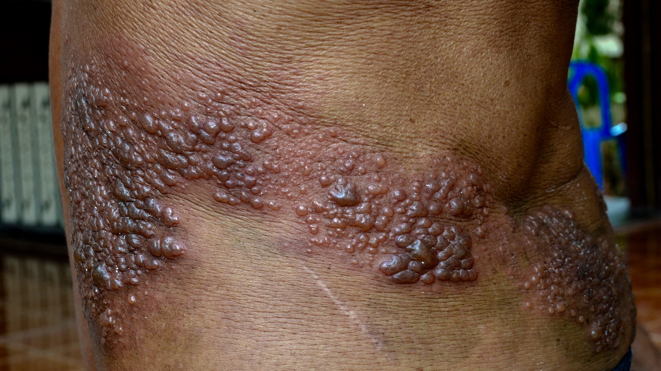 Rash and Swollen Lymph Nodes: Causes, Photos, and Treatment
