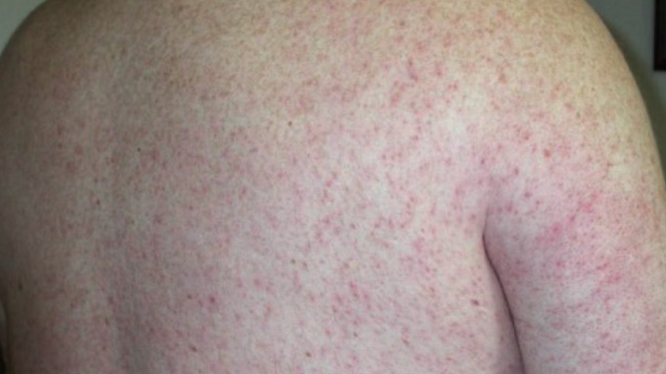 Rash and Swollen Lymph Nodes: Causes, Photos, and Treatment