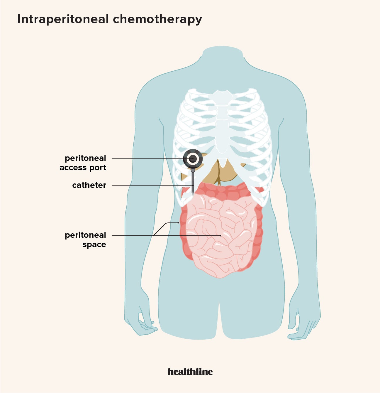 Intraperitoneal Chemotherapy: When Used, What to Expect