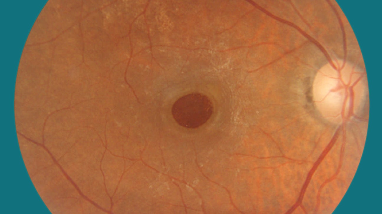 Macular Hole: Diagnosing and Treating This Tricky Eye Problem