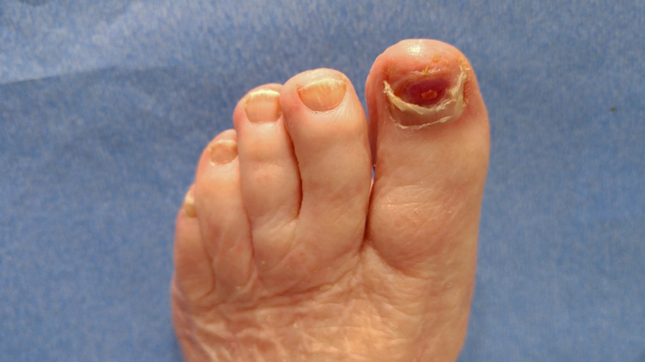 Rheumatoid Arthritis Rashes: Pictures, Symptoms, & Treatments