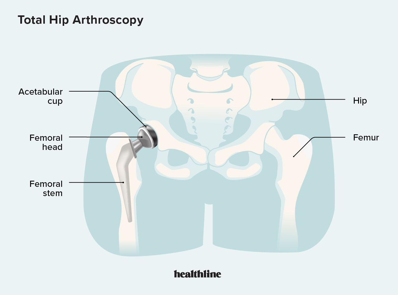 Total Hip Arthroplasty Total Hip Arthroplasty