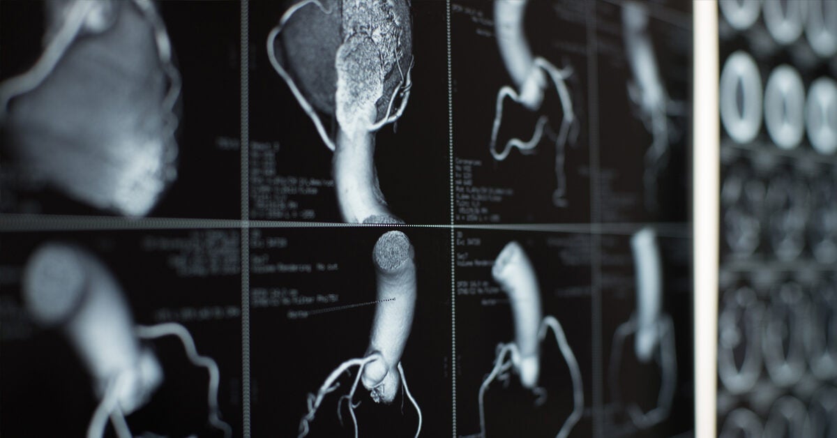 Cholesterol Artery Test: Coronary Artery Calcium Test and Score