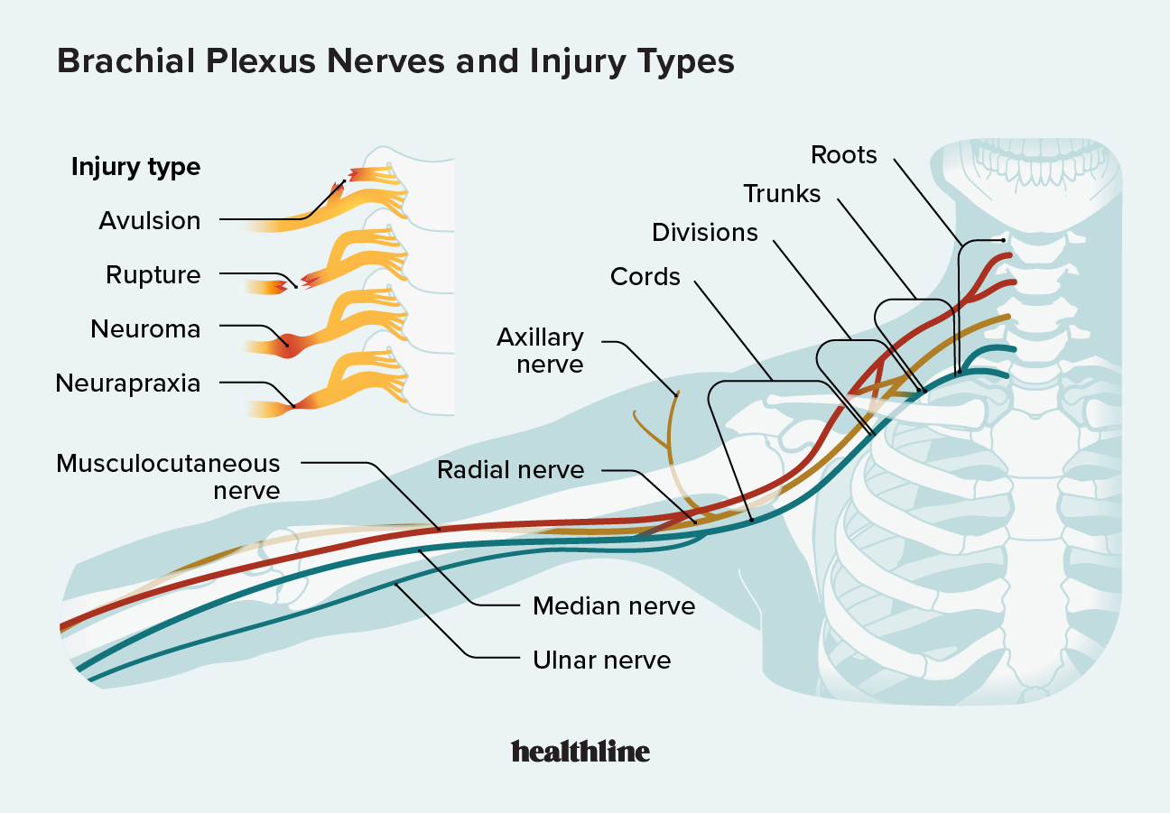 Brachial Plexus Injury Symptoms Diagnosis Treatment