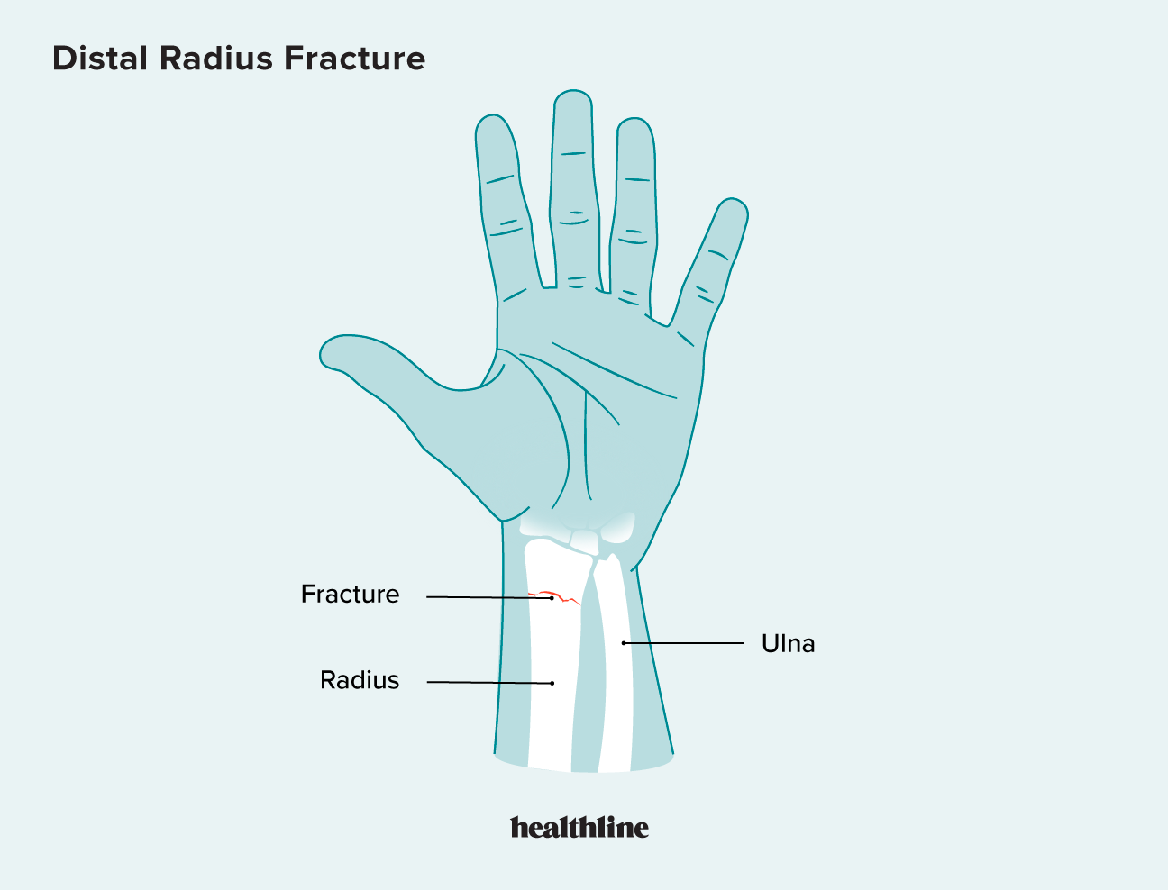 Radial Styloid Fracture Splint Moore Fracture LITFL Medical Blog Radial Styloid Fracture Splint Moore Fracture LITFL Medical Blog