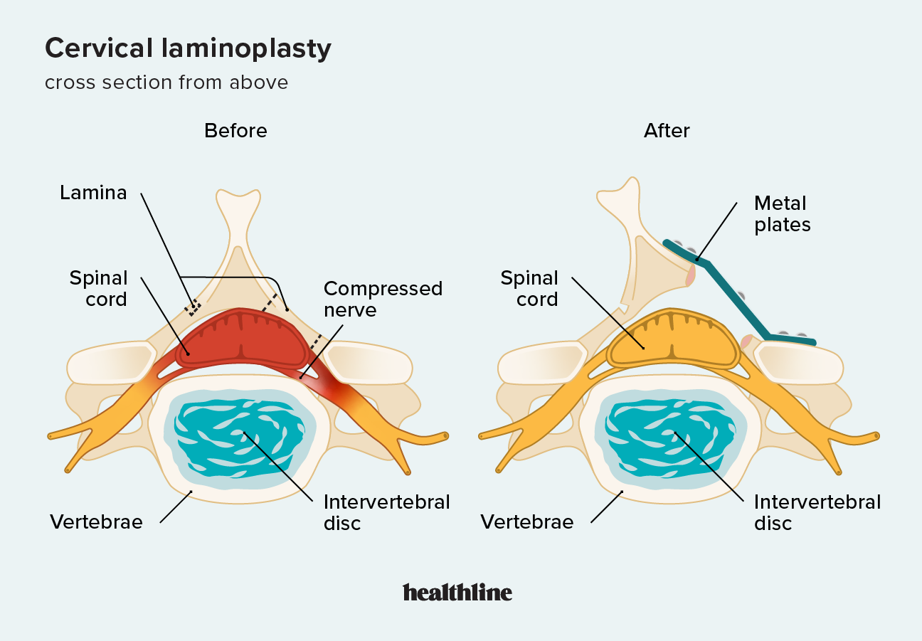 Laminoplasty Surgery Procedure Benefits Risks Recovery Laminoplasty Surgery Procedure Benefits Risks Recovery