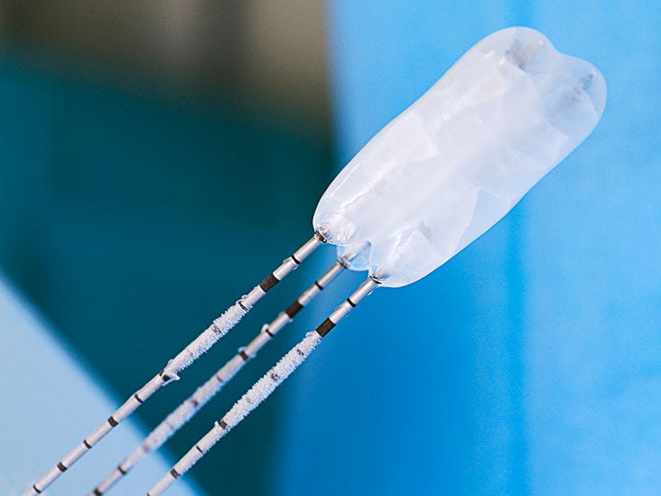 Cryotherapy for Prostate Cancer: Efficacy, Side Effects, More