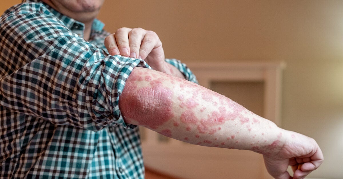 Auspitz Sign in Psoriasis: Symptoms, Causes, Treatment Auspitz Sign in Psoriasis: Symptoms, Causes, Treatment