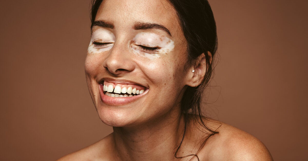 9 Tips for Boosting Confidence with Vitiligo