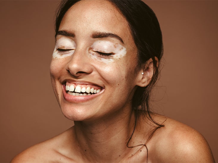 9 Tips for Boosting Confidence with Vitiligo
