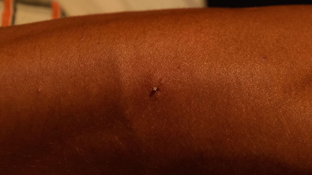 Bites and Stings: Pictures, Causes, Symptoms, and Treatment