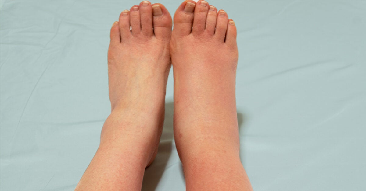 Cellulitis When To Worry Symptoms Not To Ignore Cellulitis When To Worry Symptoms Not To Ignore