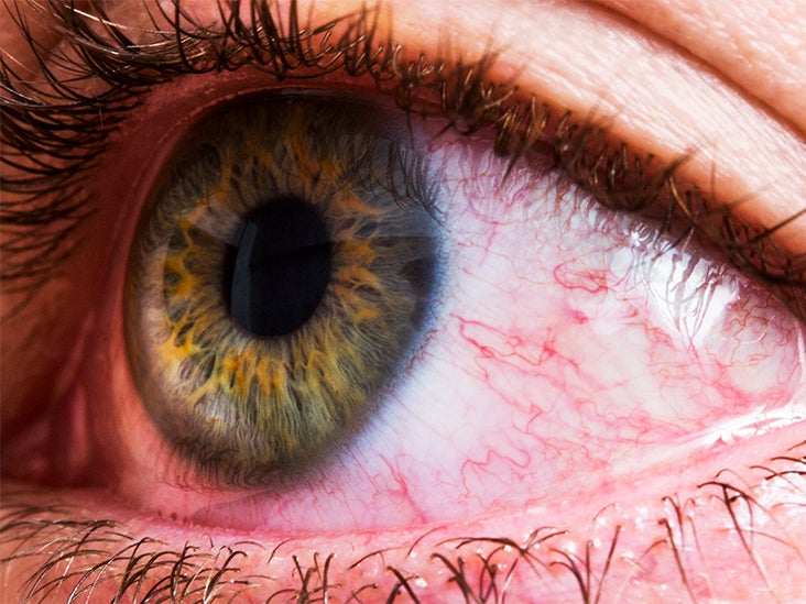 Lupus and Dry Eyes: Causes, Diagnosis, and Treatment