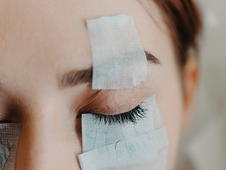 Blepharitis from Eyelash Extensions: How to Treat and Prevent It