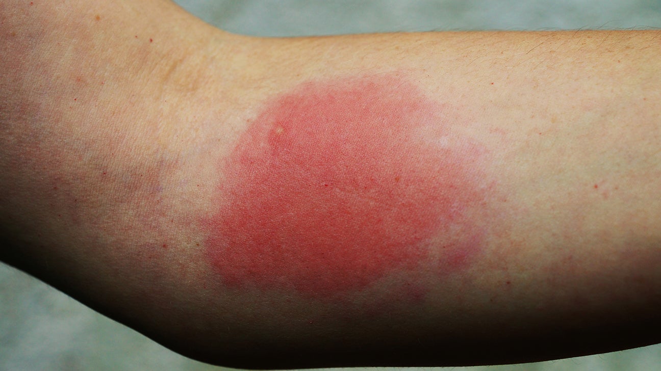 Bites and Stings: Pictures, Causes, Symptoms, and Treatment