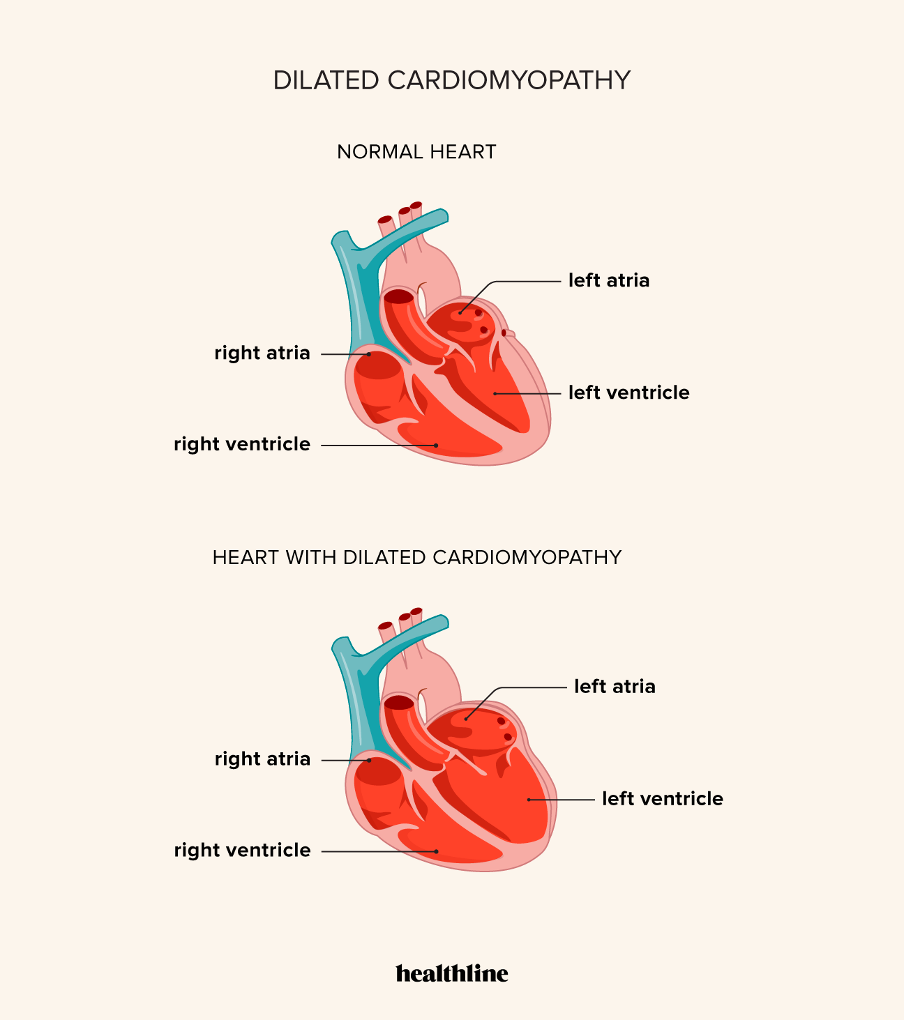Dilated Cardiomyopathy Causes And Treatment
