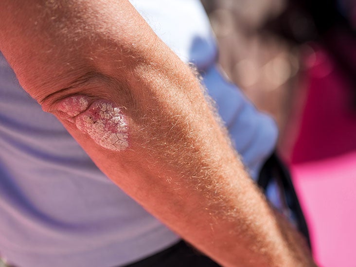 Chronic Plaque Psoriasis Symptoms Treatment And More