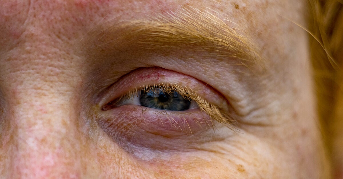 Is Blepharitis Contagious What You Need To Know Is Blepharitis Contagious What You Need To Know