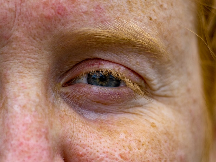 Is Blepharitis Contagious? What You Need to Know